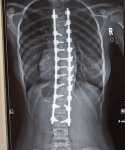 Spinal Fusion Surgery For Scoliosis – After Surgery Xray | From ...